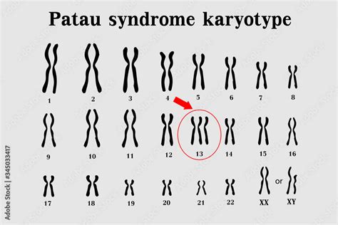 Celebrities With Trisomy Syndrome Patau Syndrome My Xxx Hot Girl
