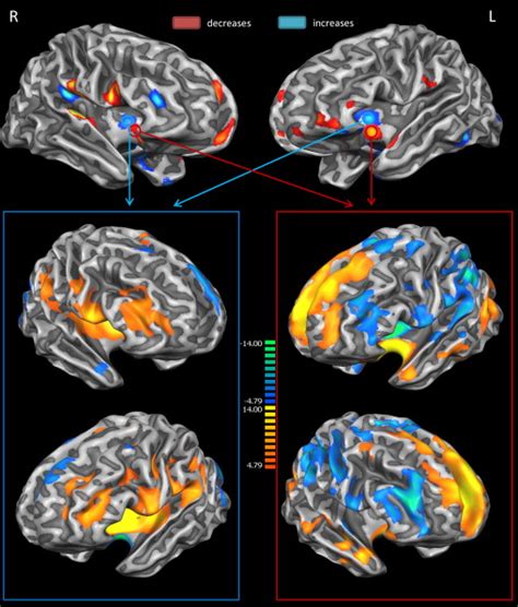 Resting State Seed Voxel Functional Connectivity Of The Two Anterior
