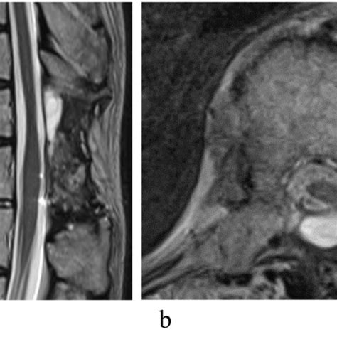 T2 Weighted Magnetic Resonance Scans Show An Extradural Cystic Lesion