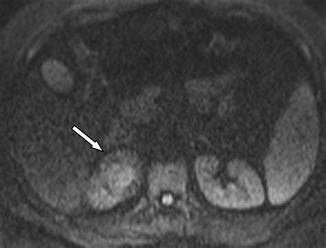 Usefulness Of Diffusion Weighted Imaging In The Evaluation Of Renal