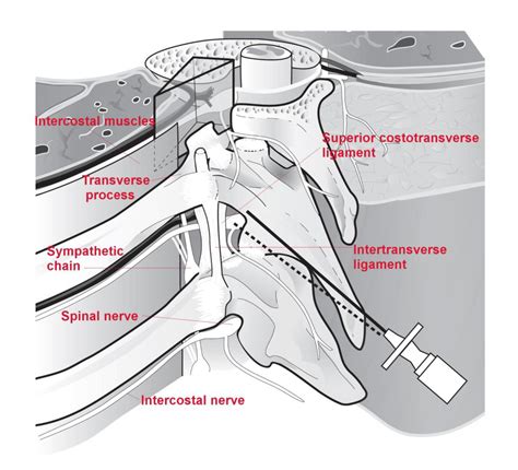 Paravertebral Block