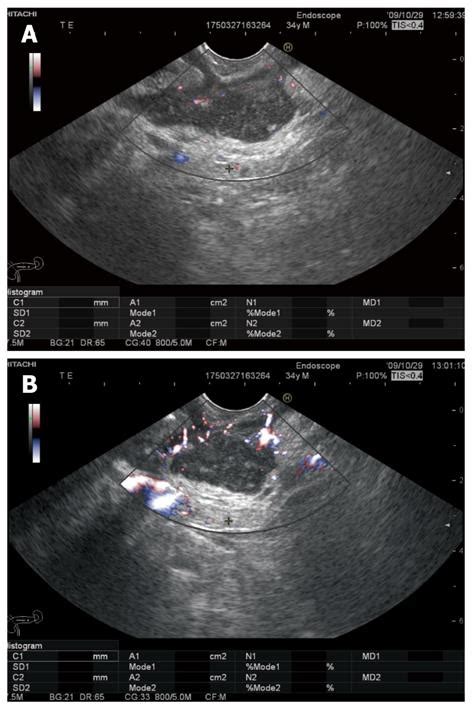 Contrast Enhanced Endoscopic Ultrasonography