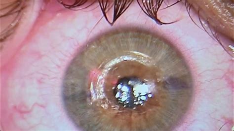 Keratoconus Surgery Femto Laser Assisted Ferrara Corneal Ring Segment