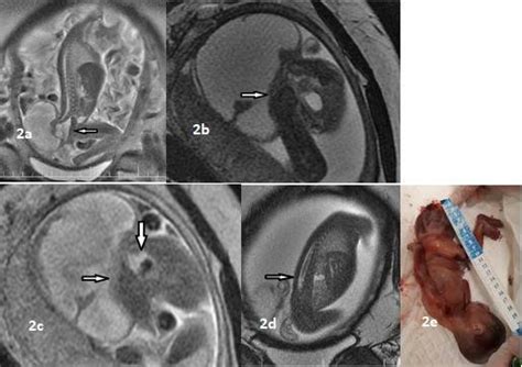 Mri Evaluation Of Sct In The Fetus 2a Sagittal Ss Fse Image Confirms