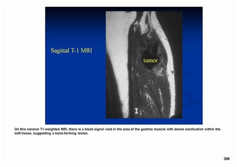 soft tissue osteosarcoma atlas of musculoskeletal oncology
