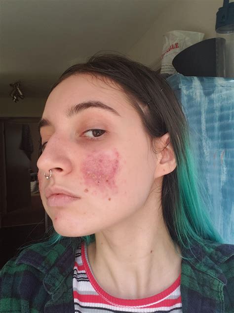 Finished My Accutane Journey 5 Months In Total Before And After Pics