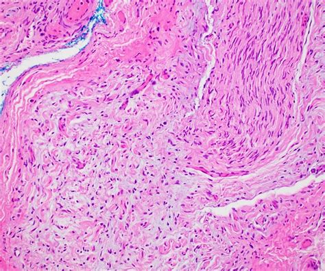 Plexiform Neurofibroma Histopathology