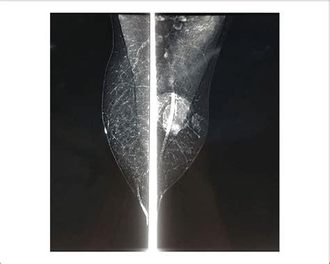 Mediolateral Oblique Mammography Showed A Subcutaneous Oval Mass With A