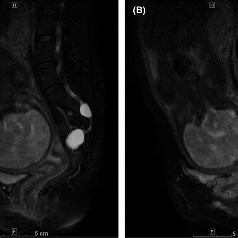 Magnetic Resonance Imaging Findings Magnetic Resonance Myelography At