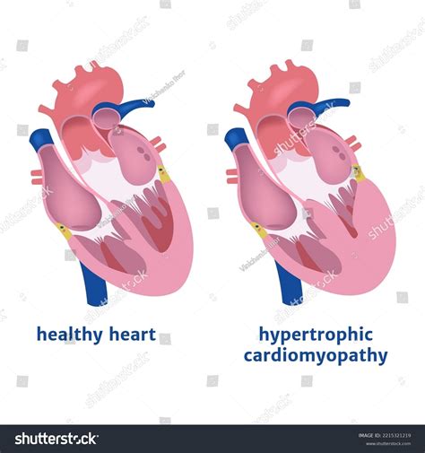 Hypertrophic Cardiomyopathy Expansion Ventricle Heart Medical Stock