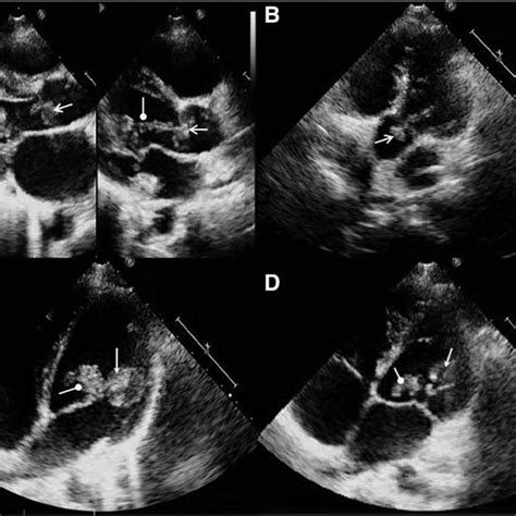 The Series Of Parasternal Long Axis Views A Through D Illustrated
