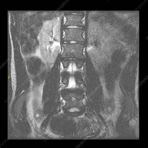 Lumbar Spine Mri In Achondroplastic Dwarf Stock Image C027 1639