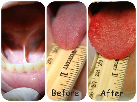 Labial Frenectomy Before And After