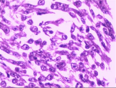 Photomicrograph Showing Markedly Pleomorphic Tumor Cells With Vesicular