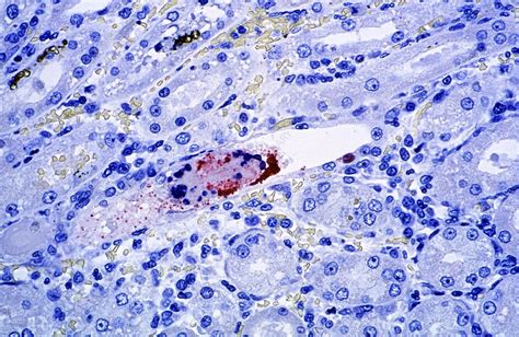 Nipah Virus Infection Light Micrograph Stock Image C036 0022