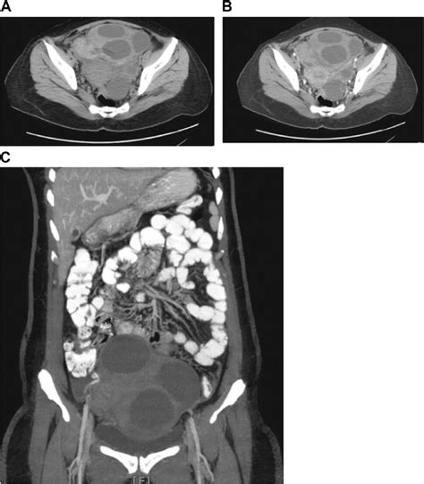 Albums 104 Pictures Pictures Of Cysts In Stomach Superb