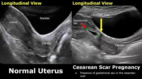 Retroflexed Vs Retroverted Uterus