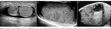 Figure 1 From Brucella And Non Brucella Epididymo Orchitis Comparison