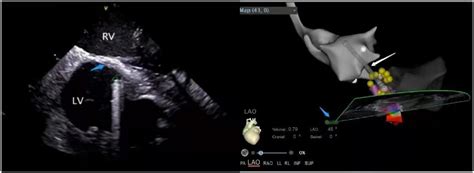 Frontiers Understanding The Scope Of Intracardiac Echocardiography In