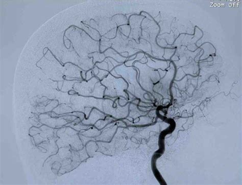 Panangiografía Cerebral Evaluación Circulación Del Cerebro