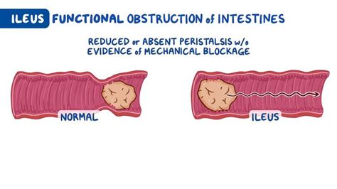 Ileus Clinical Sciences Osmosis Video Library