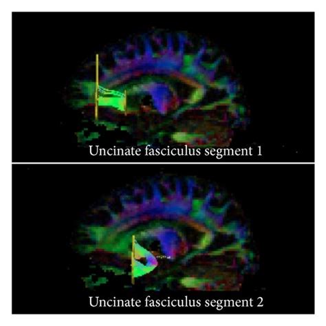 3d Tractography In Trackvis In All Tract Segments In One Patient In