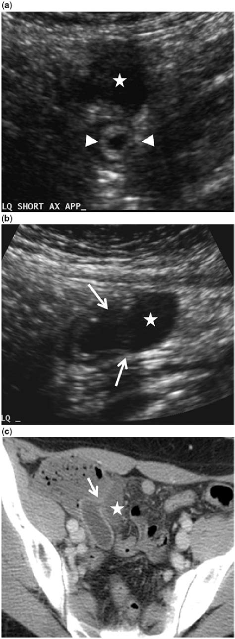 A 50 Year Old Woman With Mucinous Neoplasm Of The Appendix And