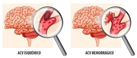 Derrame Cerebral Severo Síntomas Tratamientos Y Línea De Tiempo