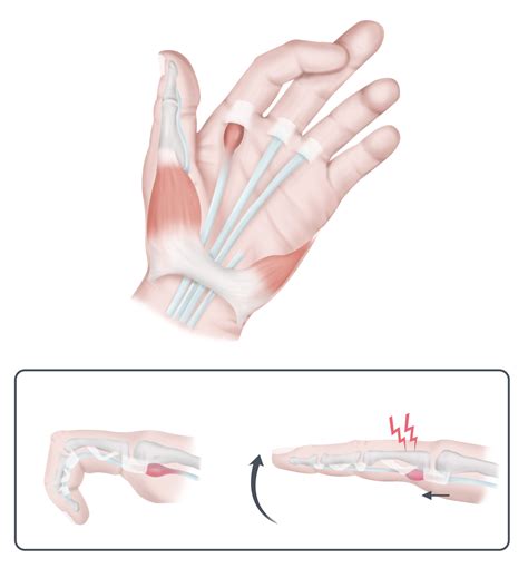 Trigger Finger Sw Shoulder Elbow And Hand