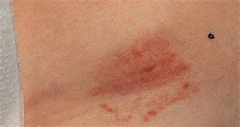 physician diagnosed erythema migrans and erythema migrans like rashes