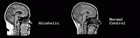 Inside The Alcoholic Brain The Psychology And Neuropsychology Of
