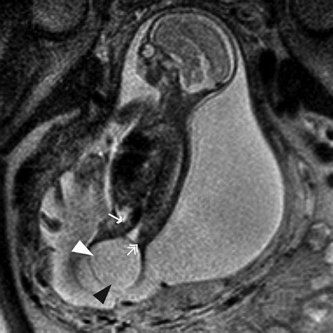 Diagnosis And Characterization Of Fetal Sacrococcygeal Teratoma With