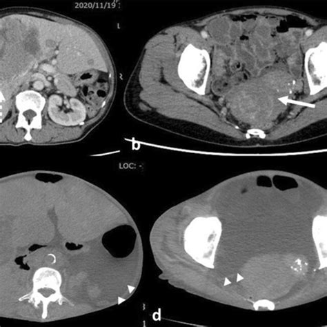 Computed Tomography Scans A B Enhanced Body Computed Tomography Scan
