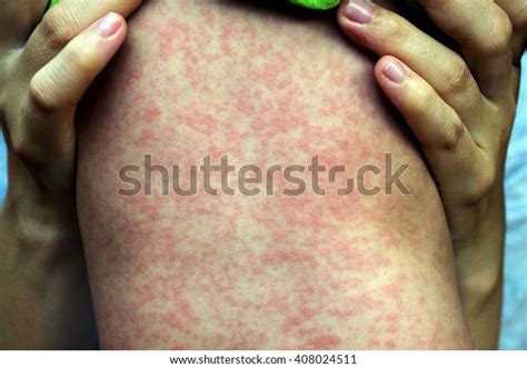 3 211 Imágenes De Measles Rash Imágenes Fotos Y Vectores De Stock