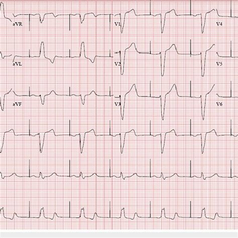 Ecg After Permanent Pacemaker Implantation Showing Atrial Paced Rhythm