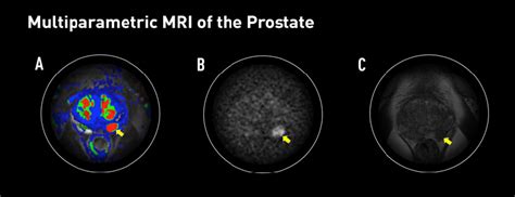 Multiparametric Mri Ultrasound Fusion Biopsy Improves Prostate Cancer