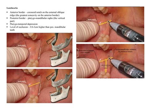 Inferior Alveolar Nerve Block Landmarks Anterior Border Coronoid
