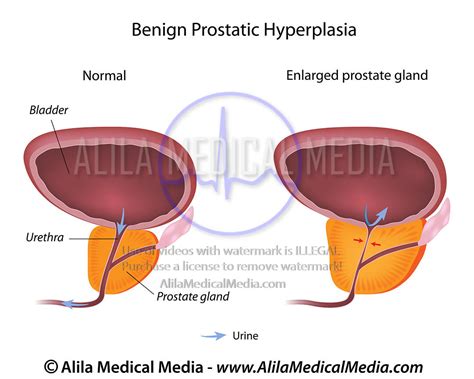 Alila Medical Media Benign Prostatic Hyperplasia Bph Medical