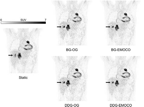 Clinical Evaluation Of A Data Driven Respiratory Gating Algorithm For