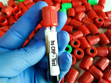 High Sensitivity C Reactive Protein Hs Crp