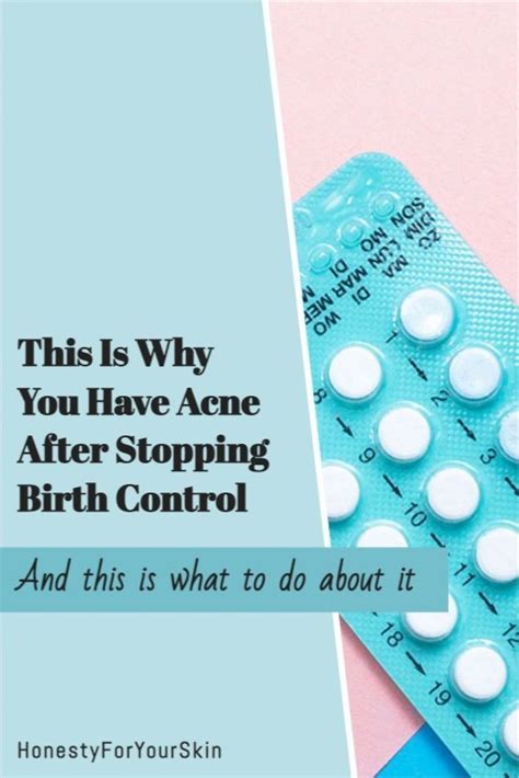 Acne After Stopping Birth Control Help Why Do I Have It What Can I