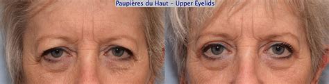 Blépharoplastie Blepharoplasty Avant And Après Photos Before And