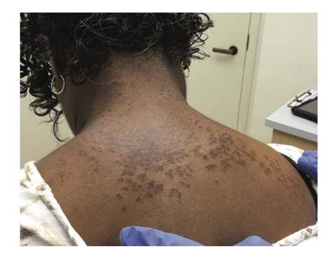 Scalp Sarcoidosis Another One Of The Great Mimickers — Donovan Hair Clinic