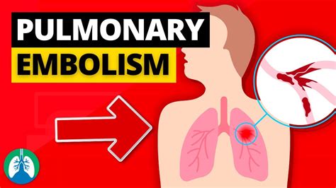 Pulmonary Embolism Medical Definition Quick Explainer Video Youtube