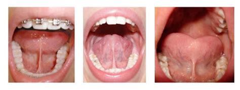 Whats A Posterior Tongue Tie Faceology