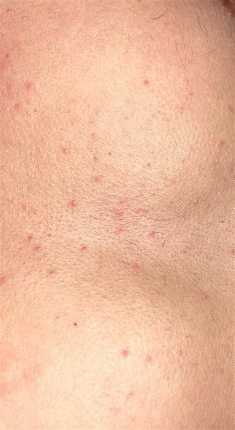 Does This Look Like A Hiv Rash R Hiv