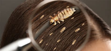 Best 8 Homeopathic Remedies For Eliminate Head Lice