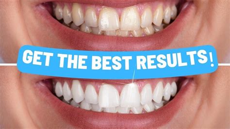 The Ultimate Teeth Whitening Guide Step By Step Instructions For Home