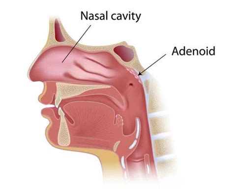 Tonsillectomy And Adenoidectomy Owings Mills Md