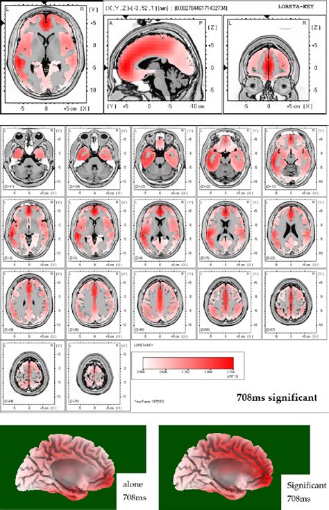 Figure 1 From Electroencephalography Eeg Reveals Increased Frontal